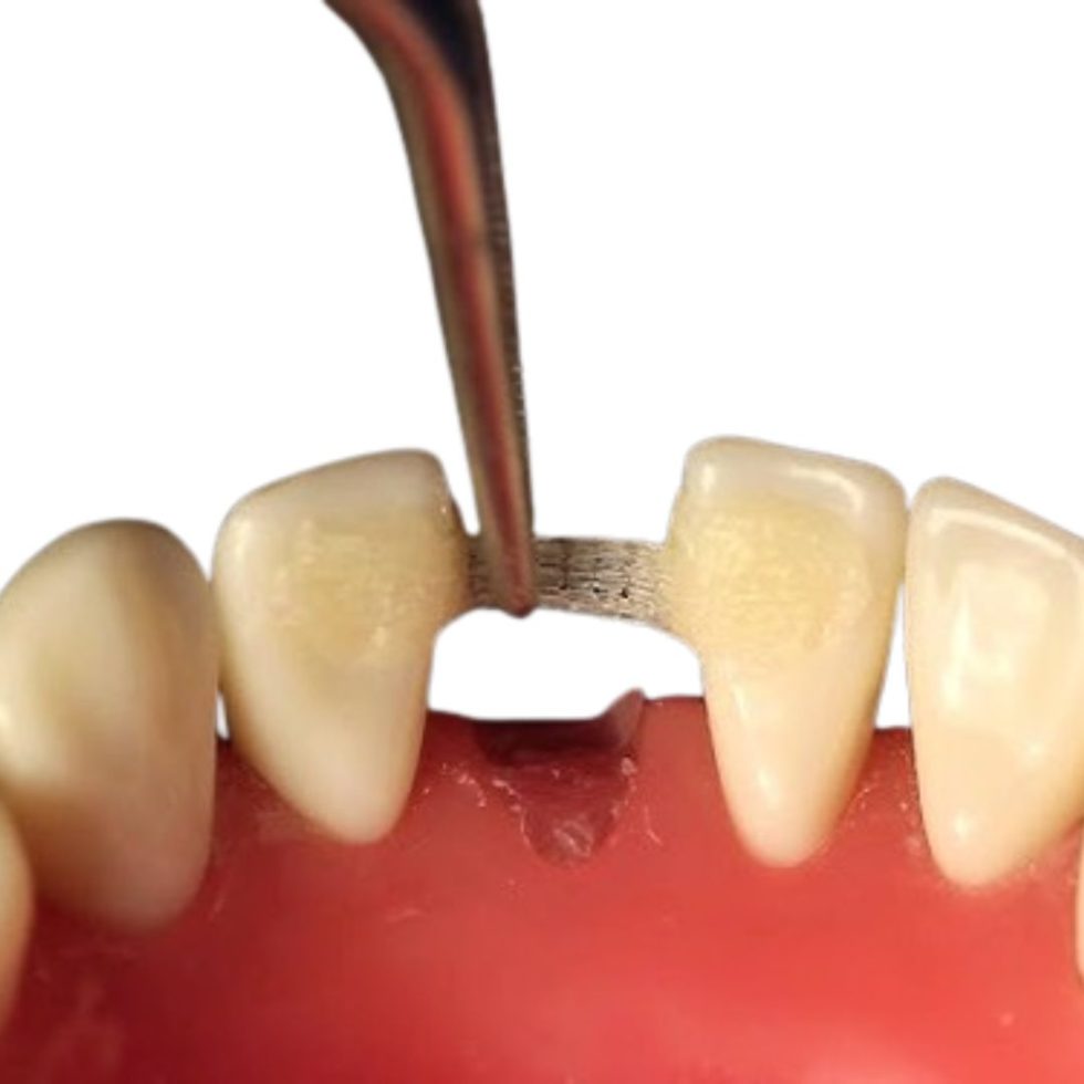 treatment-Direct-Fiber-Bridge | Dental+